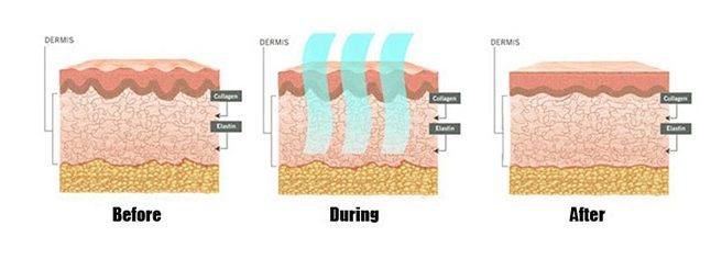 LASER RADIO FREQUENCY (RF): RADIO FREQUENCY LASER