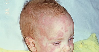 Pediatrics Notes: Introduction To Different Skin Erythemas In Children
