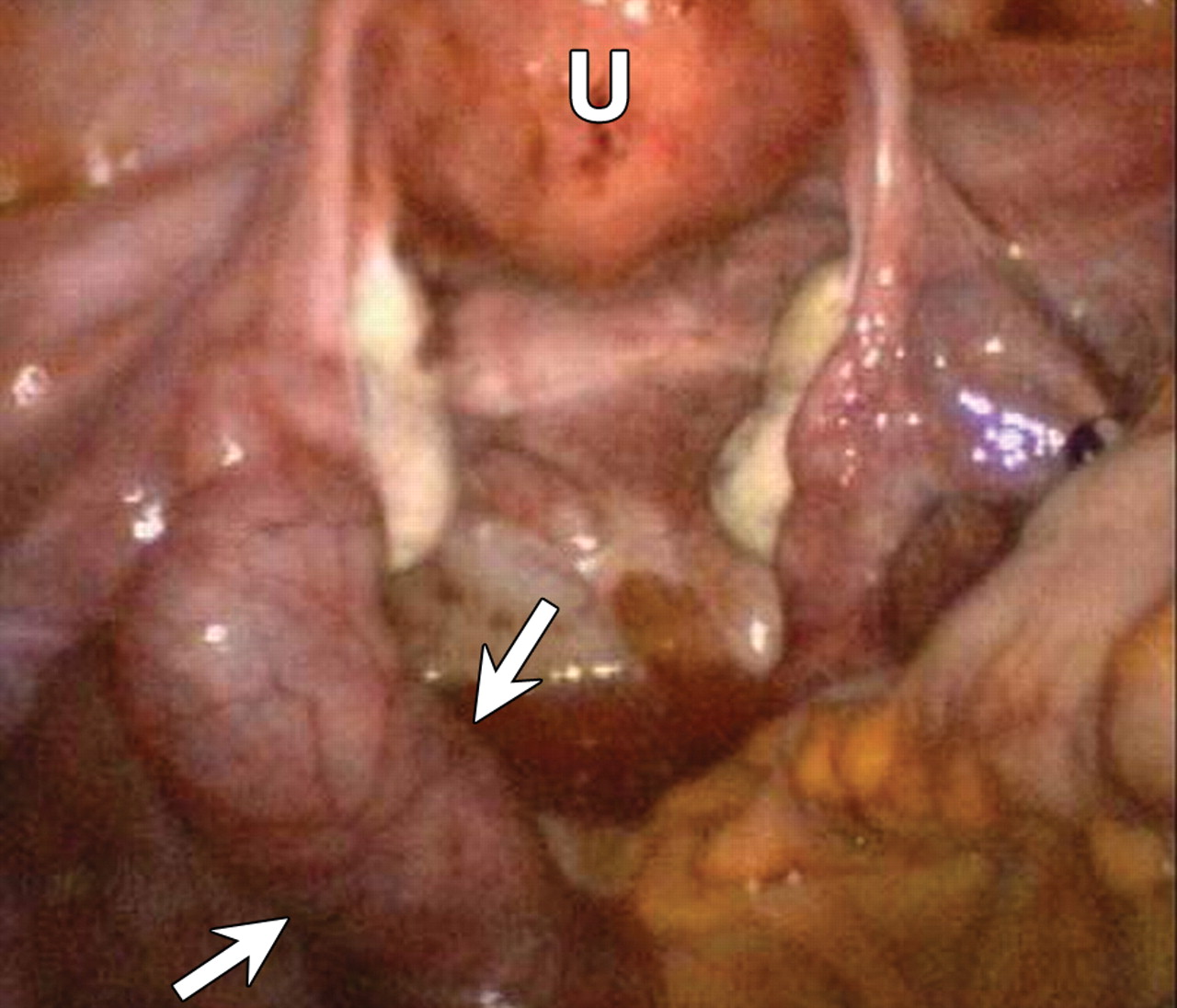 Salpingitis