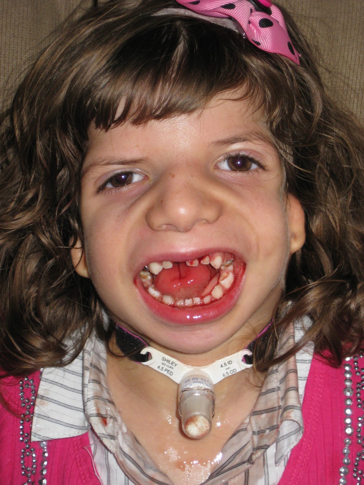 Cicily's Adventures: Front teeth