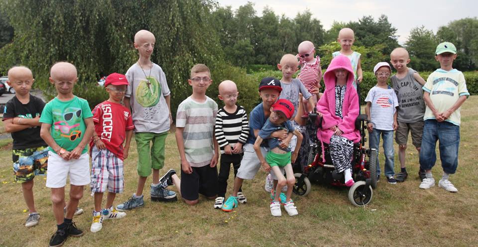 Atypical Progeria Syndrome Harry's story : Meet some of our Progeria Family