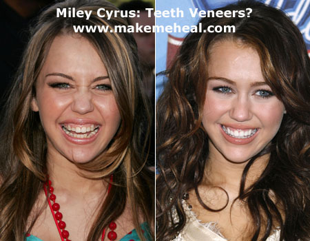Miley cyrus plastic surgery before and after | World Celebrity