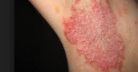 Cara mengatasi ketiak atau ketek gatal - obat herbal ampuh de nature