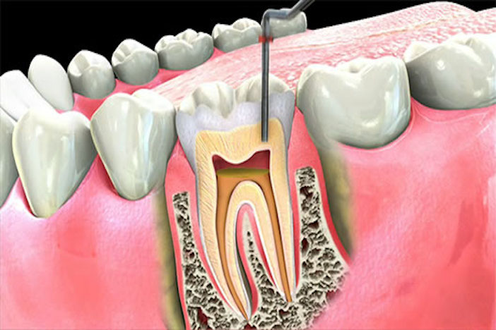 Principles and Practices of Filling Root Canals