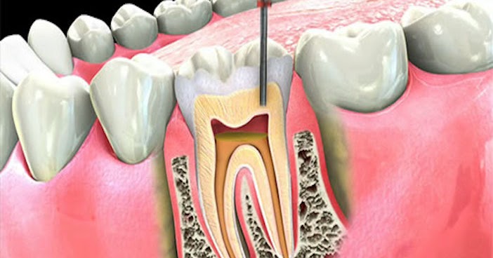 Principles and Practices of Filling Root Canals
