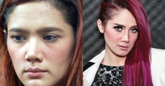 39+ Foto Artis Indonesia Yang Operasi Plastik