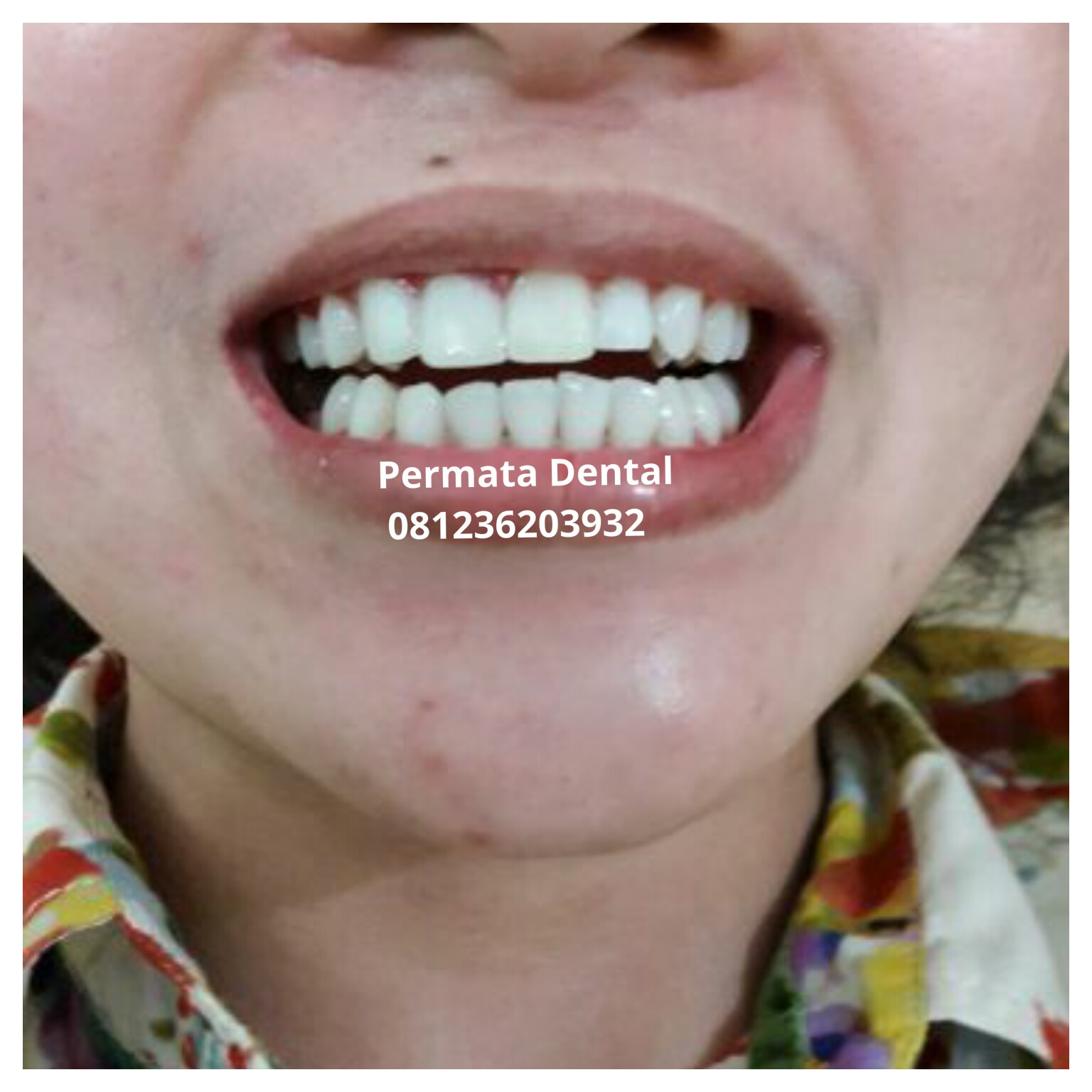 DOKTER GIGI BALI: Veneer Gigi | Samsung Gigi
