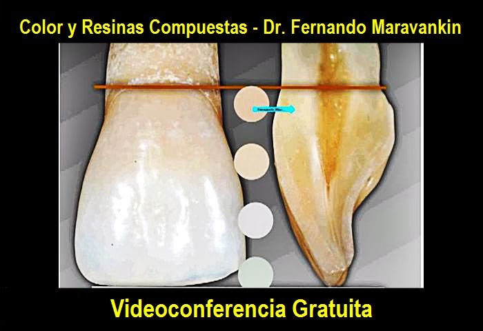 RESINAS COMPUESTAS: La elección del Color - Dr. Fernando Maravankin