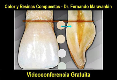 RESINAS COMPUESTAS: La elección del Color - Dr. Fernando Maravankin