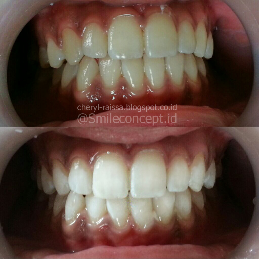 First Time Bleaching Gigi - SmileConcept | Cheryl Raissa