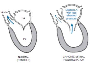 Belajar Kardiologi: Regurgitasi Mitral