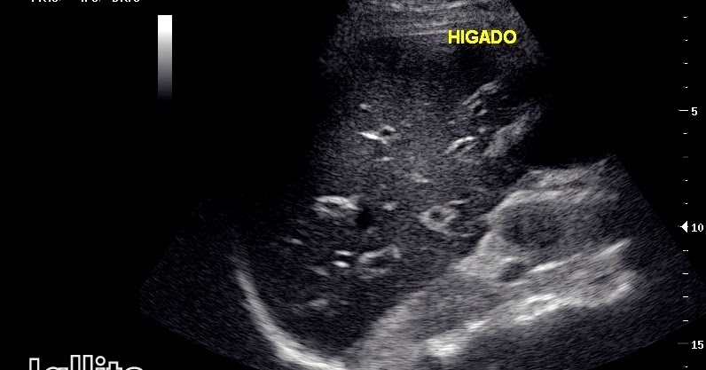 Apendicitis Perforada