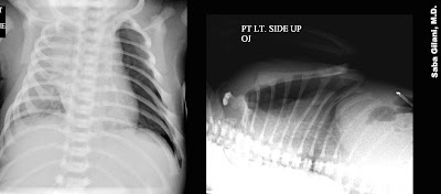 Roentgen Ray Reader: The Deep Sulcus Sign