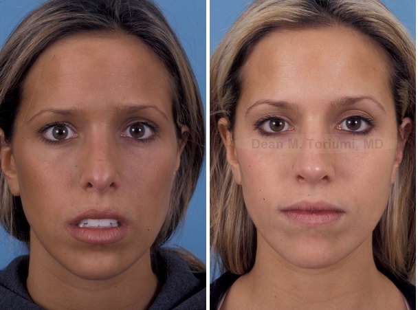 Dr. Dean Toriumi Reviews: Dean Toriumi: Secondary Rhinoplasty