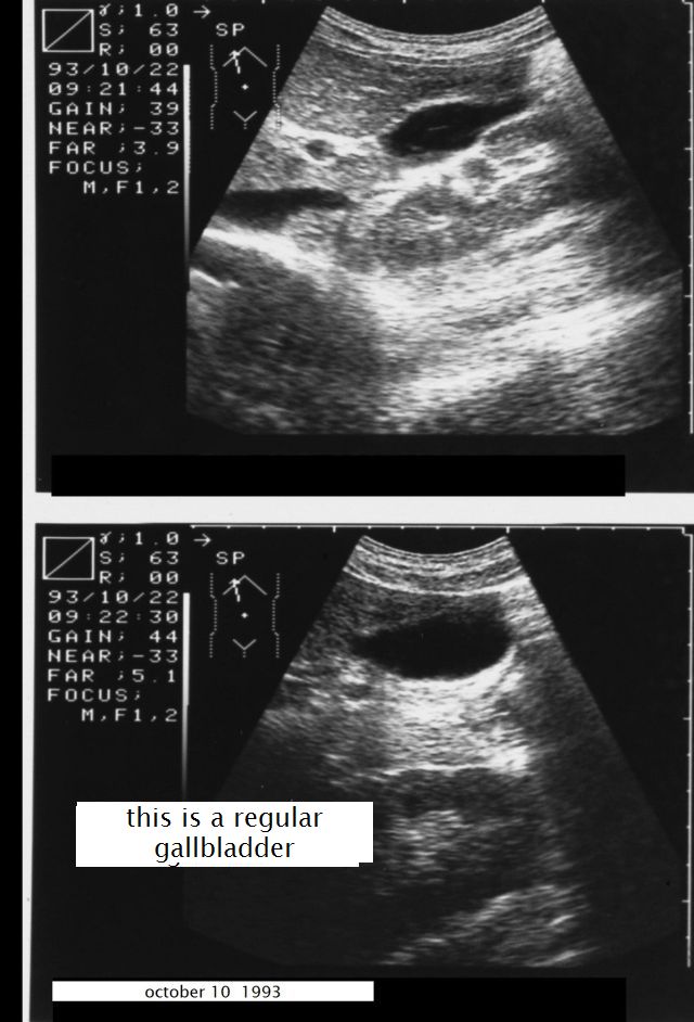hourglass gallbladder