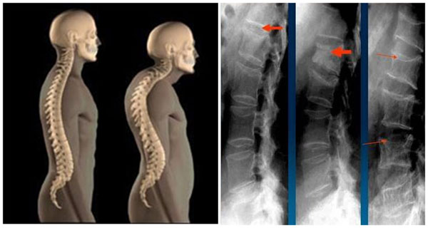 Neuro Operations: Thoracic Spine