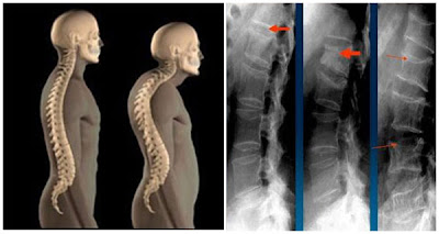 Neuro Operations: Thoracic Spine