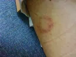 TERAPI DAN RAWATAN ISLAM: LEBAM-LEBAM DI ANGGOTA BADAN