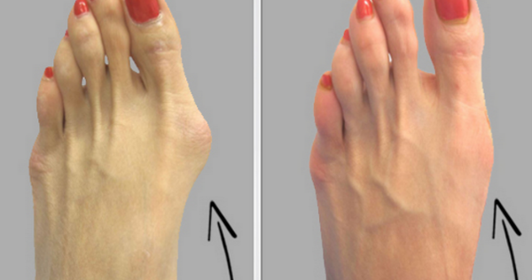 ZA OVO VAM NE TREBA OPERACIJA: 5 načina da otklonite čukljeve i ...