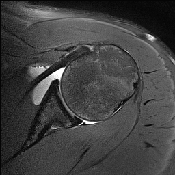 Radiology Cases: Peripheral Vertical Longitudinal Tear Posterior Labrum
