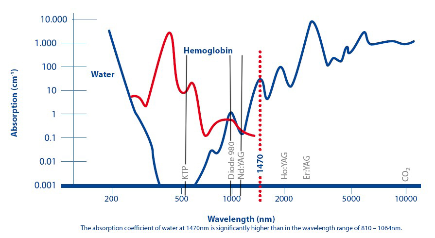 Donna: Endovenous laser ablation of varicose veins with the 1470-nm ...