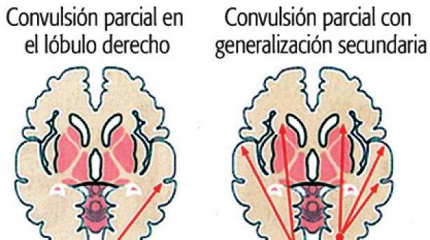 infomacion medica-epilepsia