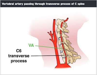Transverse Process Fractures of the Lumbar Spine