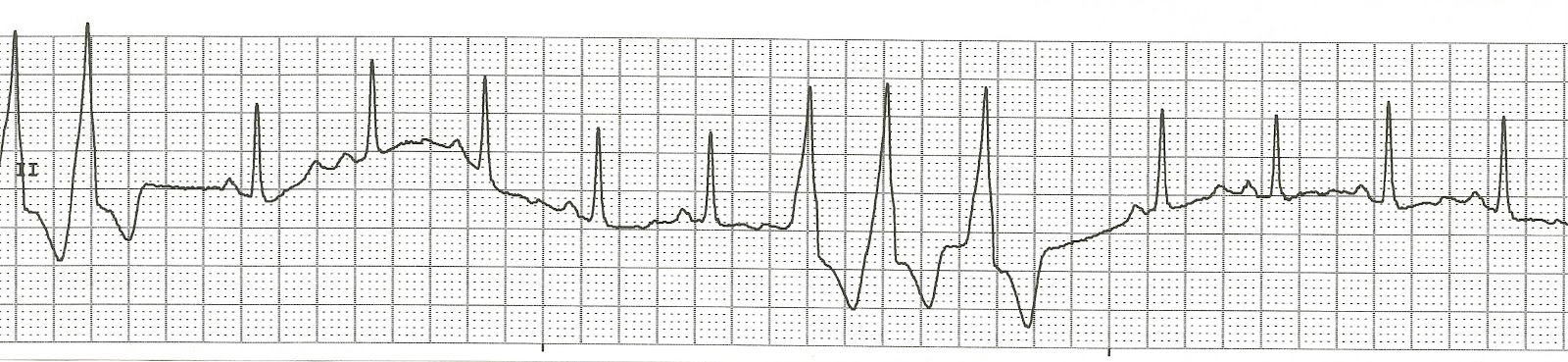 EKG Rhythm Strip Quiz 102