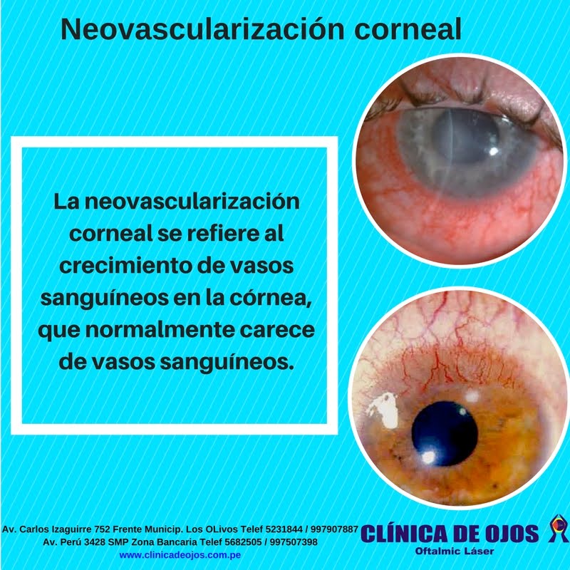 Clínica de Ojos Oftalmic Láser: Neovascularización corneal