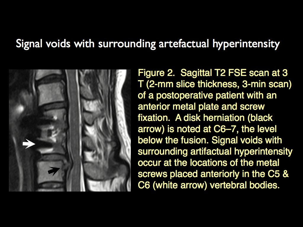 MRI BLOG: Magnetic Susceptibility Artefact