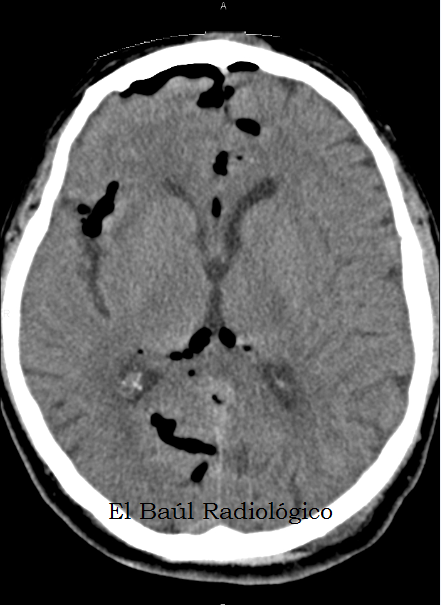 El Baúl Radiológico: NEUMOCÉFALO: 1) NEUMOCÉFALO POSTRAUMÁTICO ...