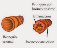 Construyendo una familia: Broncoespasmos y respiración abdominal