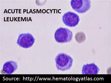 Lab Atlas: Acute Plasmocytic Leukemia
