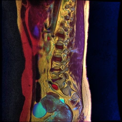 Nevit's blog: Color MRI of the Lumbar spine with extruded disc