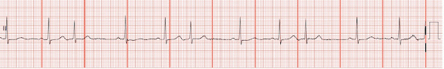 EKG Rhythm Strip Quiz 20