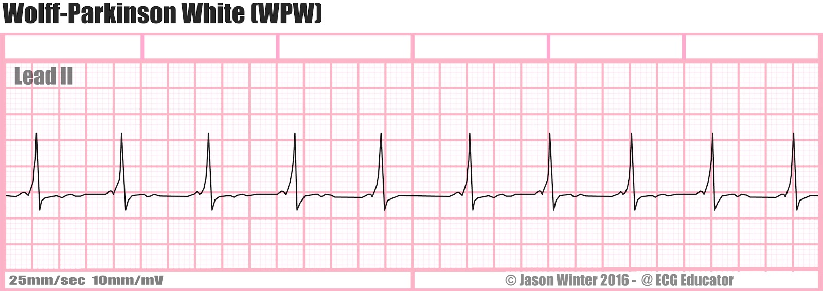 ECG Educator Blog : Six Second ECG Rhythm Strips