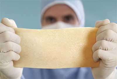 Infusiones GOVE: Alloderm