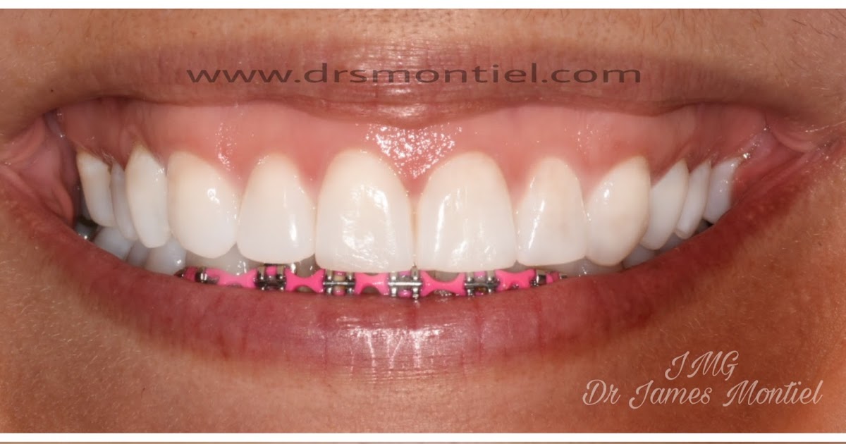 Botox, Acido Hialurónico, Bichectomia, Invisible Touch Hilos Pdo