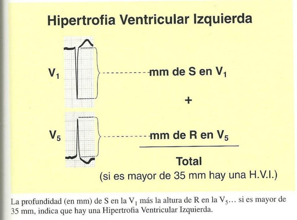 Electrocardiograma: Hipertrofia ventricular izquierda