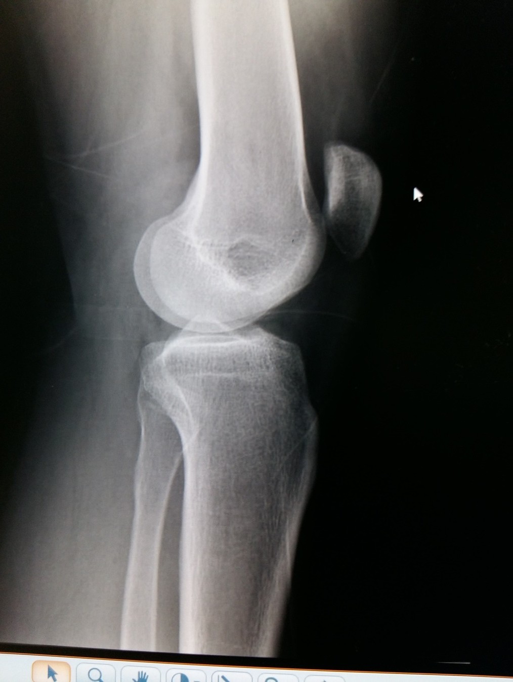 O R T O C R I T I C A: MENISCOPATIA POST TRAUMATICA