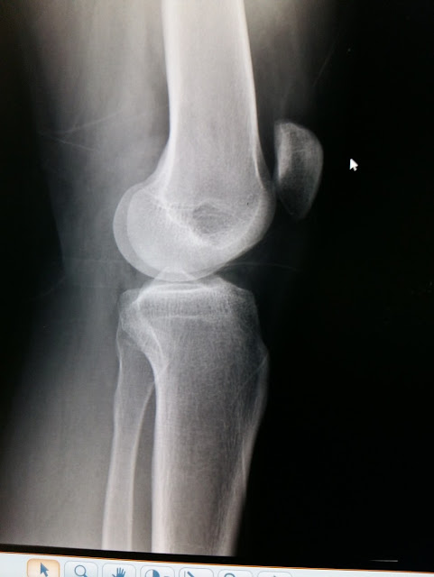 O R T O C R I T I C A: MENISCOPATIA POST TRAUMATICA