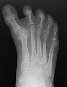 Medi Photos: Hallux varus in X-ray