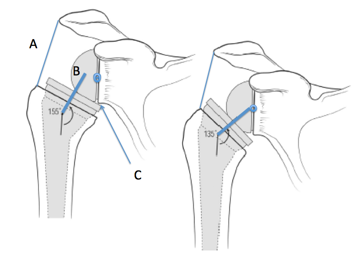 UW Shoulder and Elbow Academy: Reverse total shoulder arthroplasty ...