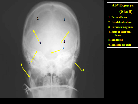 X Ray Skull Towns View