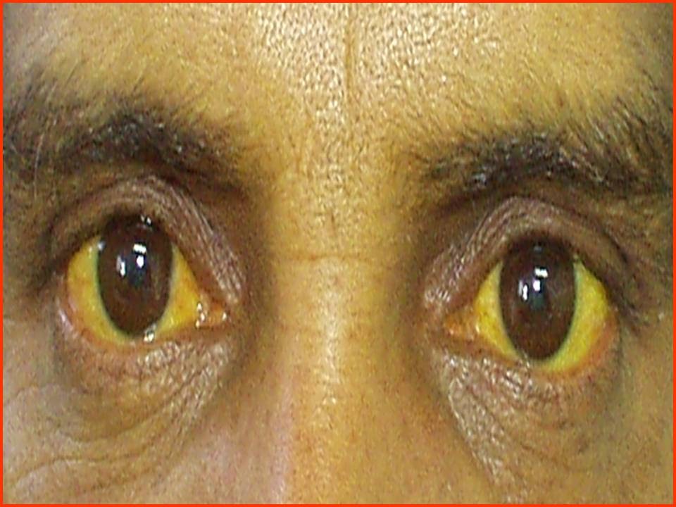 Laboratorio clinico equipo 4: Patologías del hígado