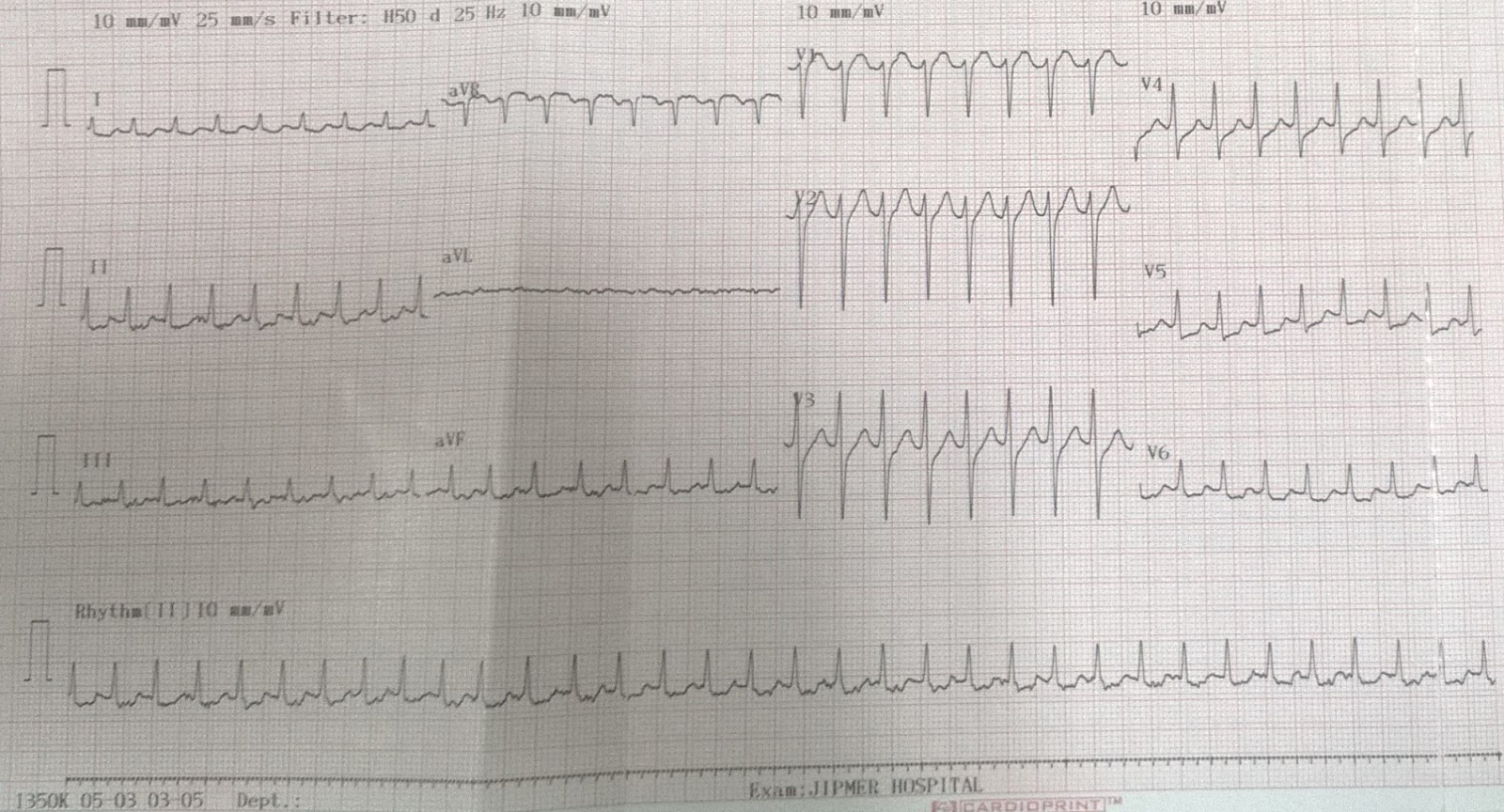 Cardiology window: Atrial tachycardia