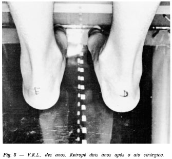Pé Plano Flácido e Pé Chato - Evolução e Tratamento