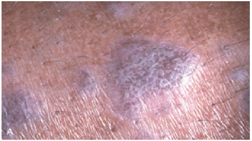 Atlas virtual de histologia e patologia: [CC II: #3] LÍQUEN PLANO