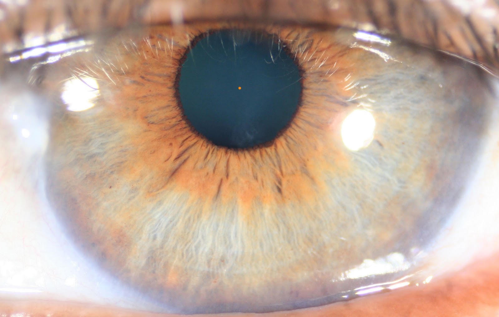 Modern & Multidimensional Iridology: IPB Morphologies & Punctate ...