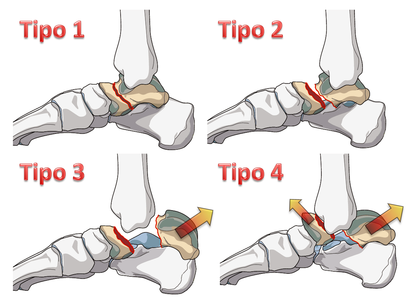Clínica e Cirurgia do Pé e Tornozelo: Fraturas do Tálus
